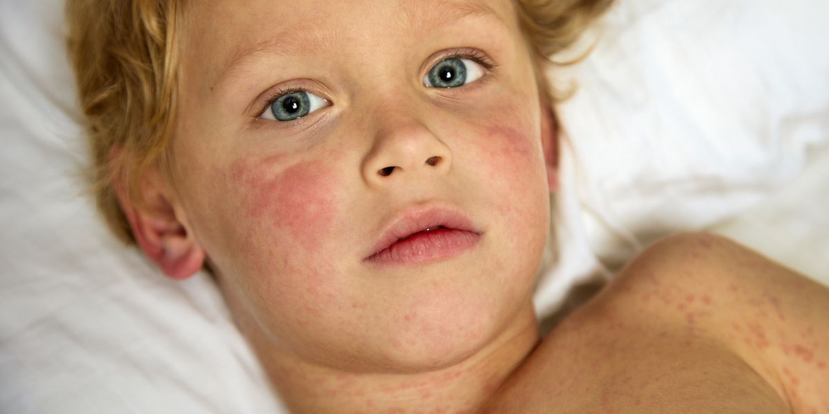 Urticaria en niños y bebés